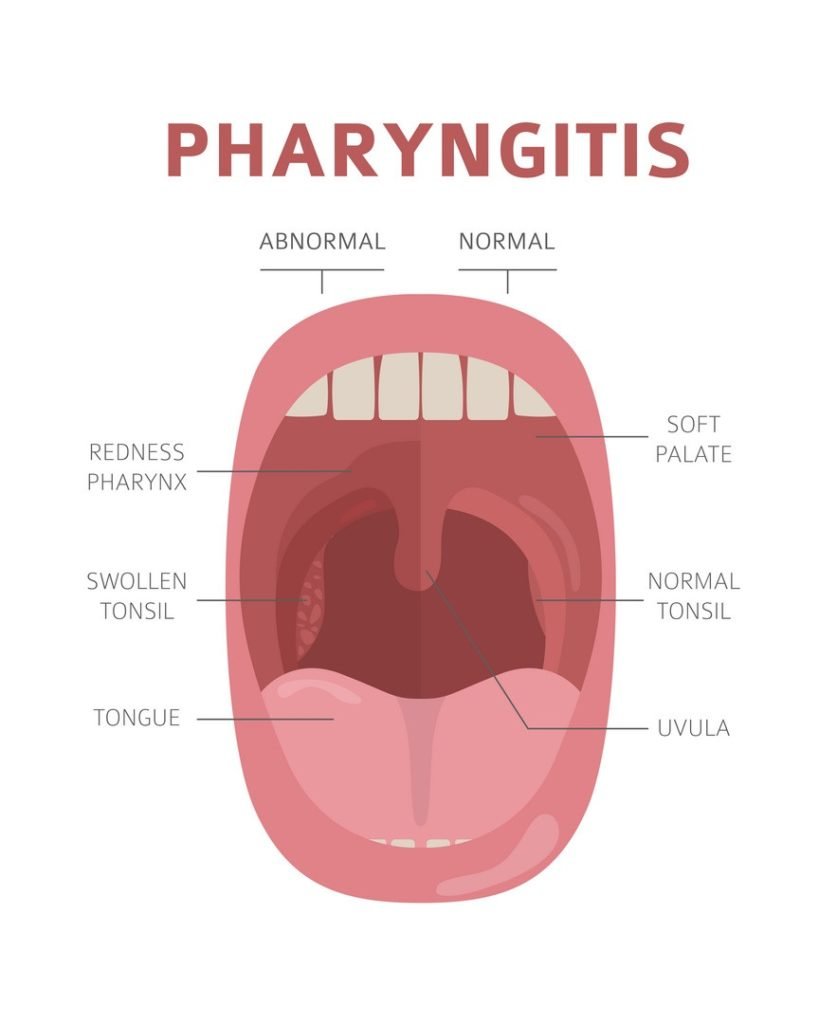 7 Kelainan dan Penyakit pada Sistem Pernapasan beserta Gambarnya dan ...